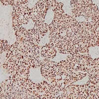Immunohistochemistry for p53 staining in Breast Cancer Tissue